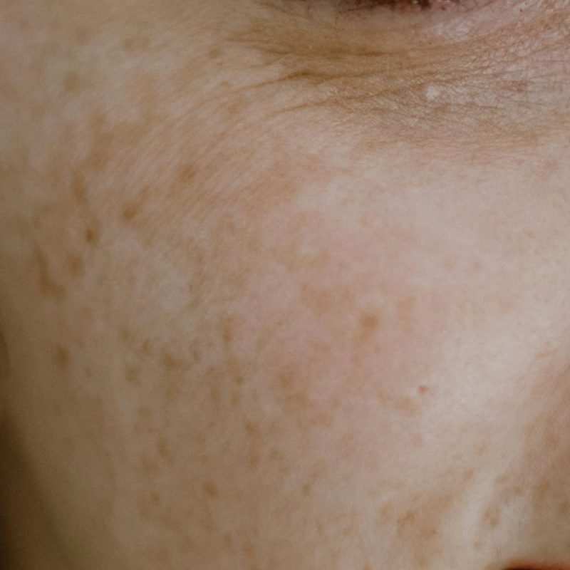Hyperpigmentation | Dr Chong Clinic | Aesthetics Clinic In Malaysia