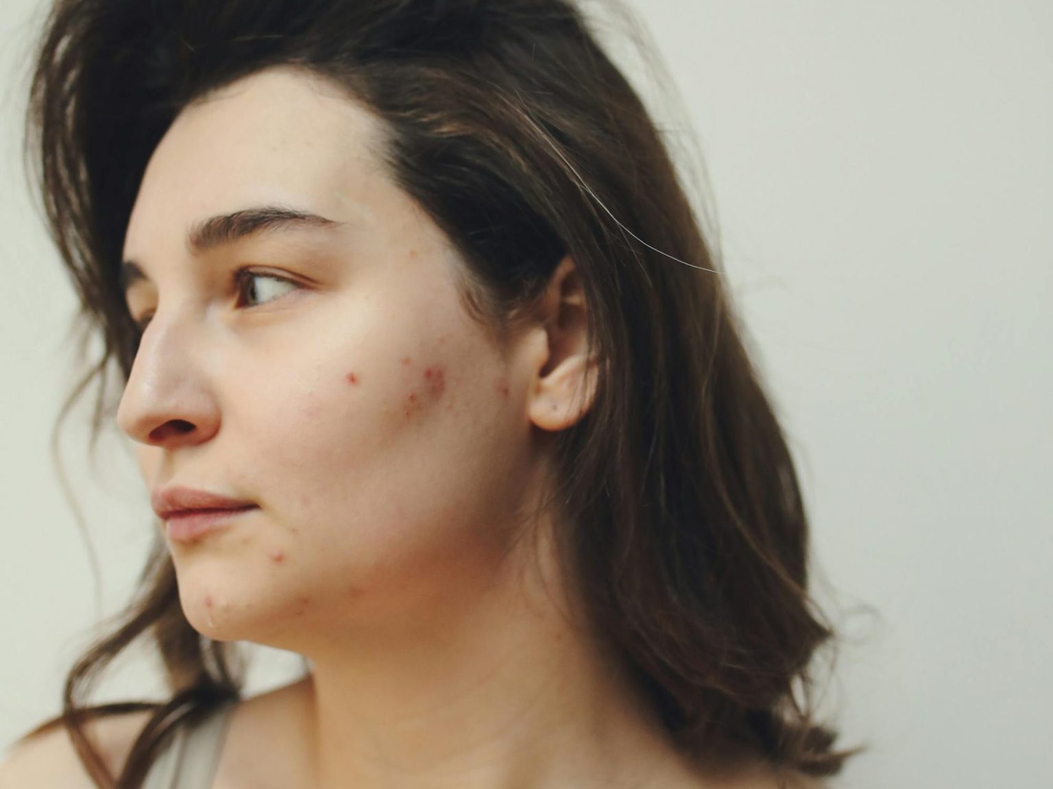 How to Lighten Acne Scars Naturally vs Professionally